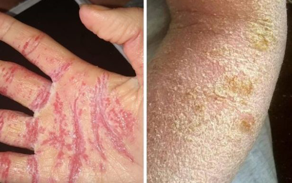 Topical Steroid Withdrawal - Everything We Know So Far | TSW Assist