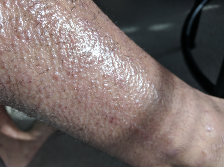 Topical Steroid Withdrawal | Symptoms, Stages, Complications, Treatment