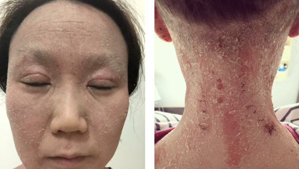 Topical Steroid Withdrawal Healing Stages | TSW Assist