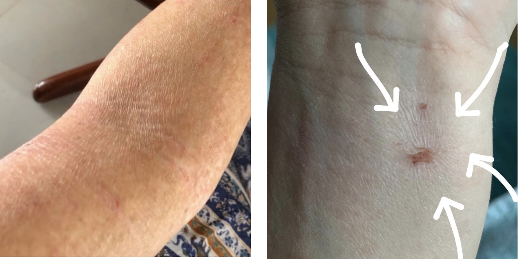 Topical Steroid Withdrawal Healing Stages | TSW Assist